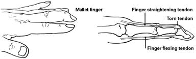 Mallet Finger: Causes, Symptoms, and Treatment