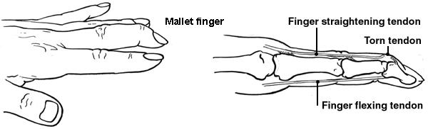 Mallet Finger: Causes, Symptoms, and Treatment