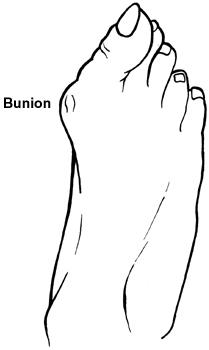 Bunions (Causes, Symptoms, and Treatment)