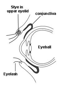 Stye (Sty): Eyelid Infection Symptoms, Causes, and Treatment