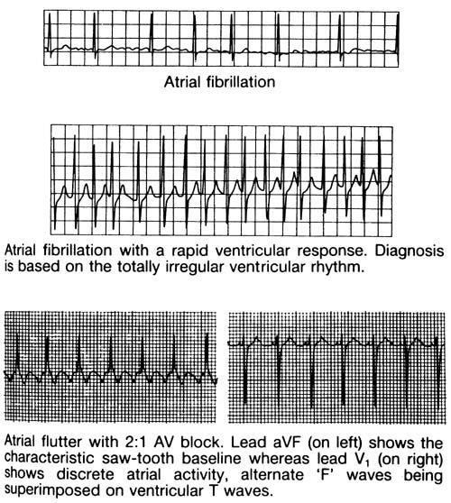 Bradycardia (Low Heart Rate): Symptoms and Treatment