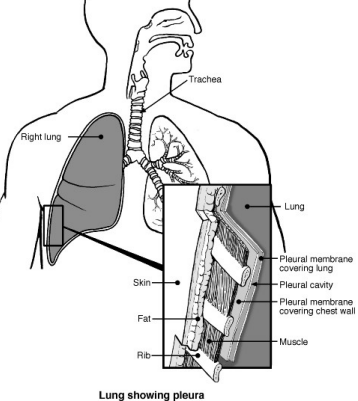 Pleurisy: Causes, Symptoms, and Treatment