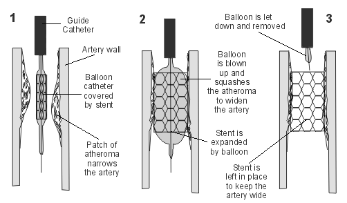 Coronary Angioplasty: Procedure and Recovery