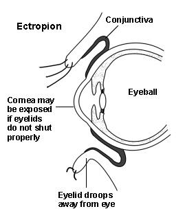 Ectropion: Causes, Symptoms, and Treatment