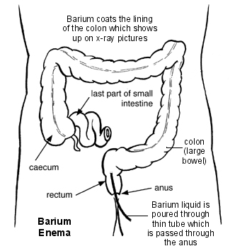 Barium Enema | Use, Preparation and Side Effects