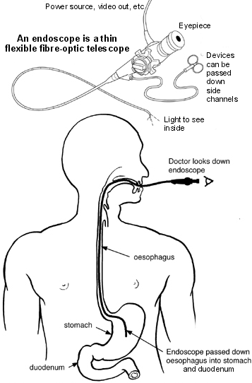 ERCP (Endoscopic Retrograde Cholangiopancreatography)
