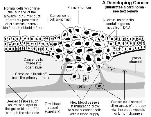 Stages of Cancer: Types of Staging
