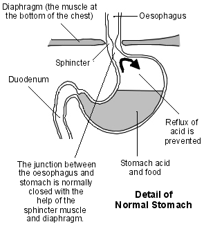 Hiatus Hernia: Symptoms, Causes, and Treatment