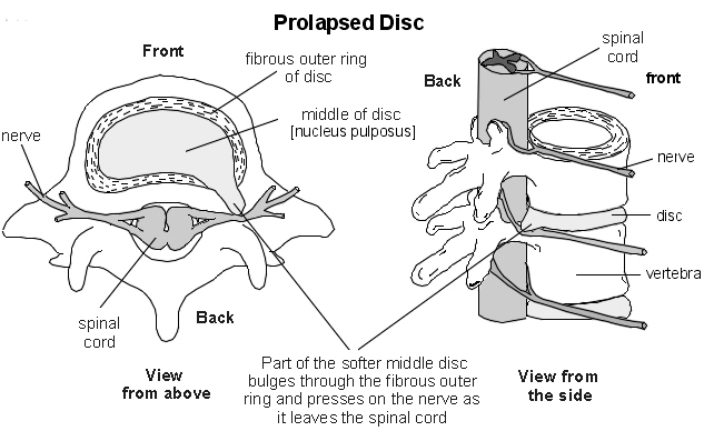 Slipped Disc: Symptoms, Causes, and Treatment