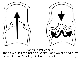 Varicocele: Causes, Symptoms, and Treatment