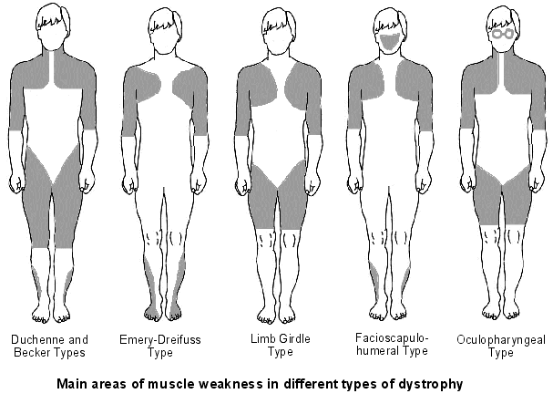Muscular Dystrophy: Symptoms, Causes, and Treatment