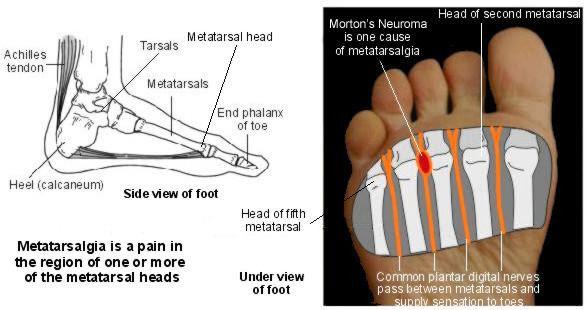 Metatarsalgia: Causes, Symptoms, and Treatment