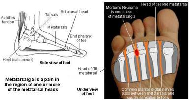 Metatarsalgia: Causes, Symptoms, and Treatment