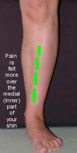 Shin Splints (Medial Tibial Stress Syndrome): Causes and Treatment