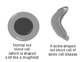 Sickle Cell Disease: Causes, Symptoms, and Treatment