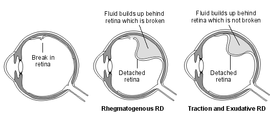 Retinal Detachment: Symptoms, Treatment, Risk Factors