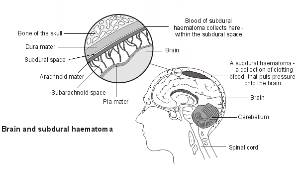 Subdural Haematoma: Symptoms and Treatment | Doctor