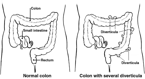 Diverticula (Diverticulosis, Diverticular Disease, Diverticulitis)