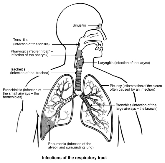Chest Infection Symptoms, Causes and Treatment
