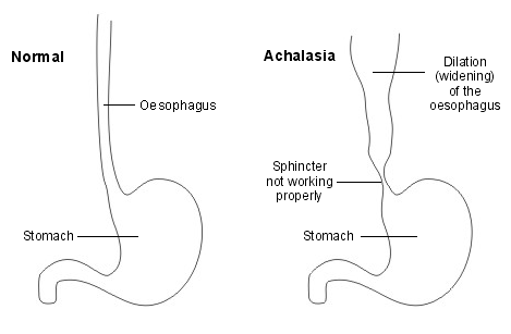 Achalasia: Symptoms and Treatment