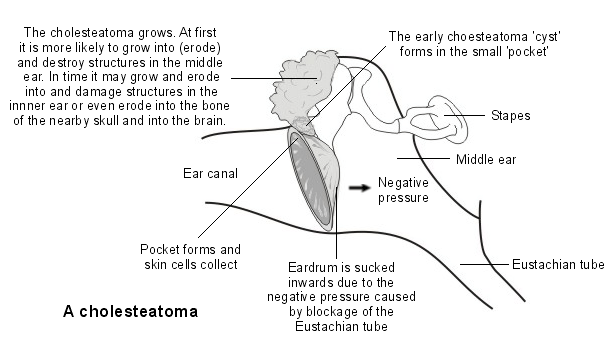 Cholesteatoma: Symptoms, Causes, and Treatment