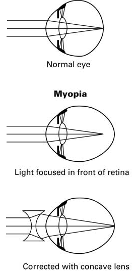 Myopia (Short-Sightedness): Symptoms, Causes, and Treatment