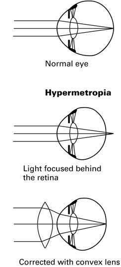 Hypermetropia (Long-Sightedness): Symptoms, and Treatment