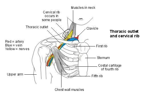 Cervical Rib (Thoracic Outlet Syndrome)