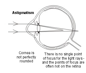 Astigmatism: Causes, Symptoms, and Treatment