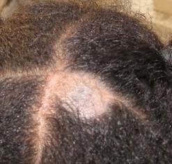 Scalp Ringworm (Fungal Scalp Infection): Diagnosis and Treatmnet