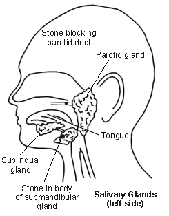 Salivary Gland Stones (Salivary Calculi) | Health