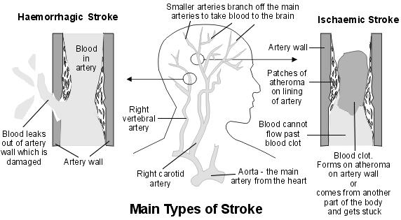 Stroke | Signs, Symptoms, Causes and Prevention