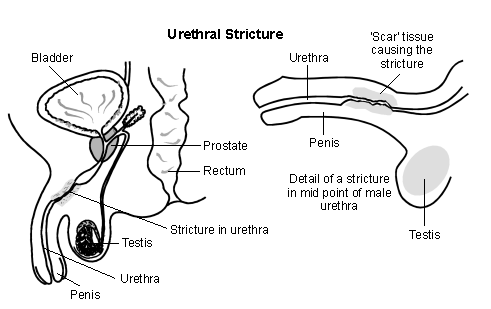 Urethral Stricture: Symptoms, Causes, and Treatment