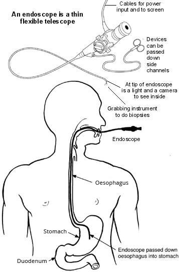 Gastroscopy (Endoscopy): Preparation and Procedure