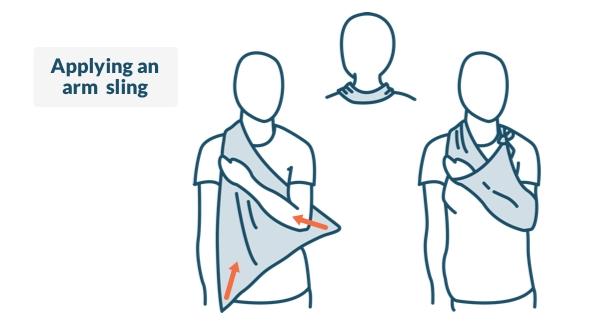 Broken Upper Arm: Symptoms, Treatment, Complications