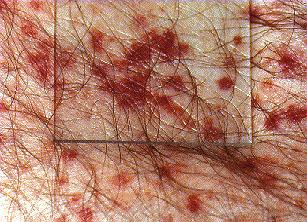 How to check for meningitis | Meningitis Symptoms Checklist