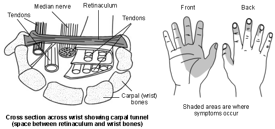 Carpal Tunnel Syndrome: Causes, Symptoms, and Treatment