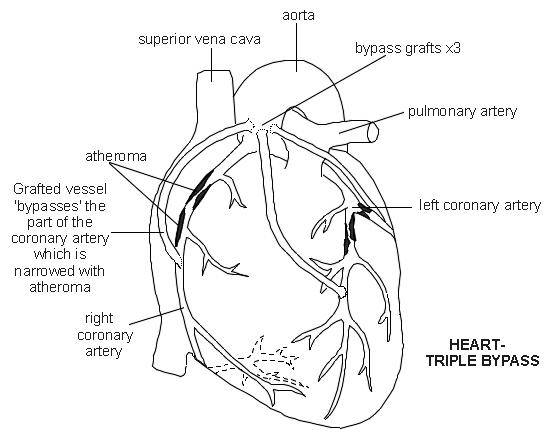 Coronary Artery Bypass Graft (CABG) | Open Heart Surgery