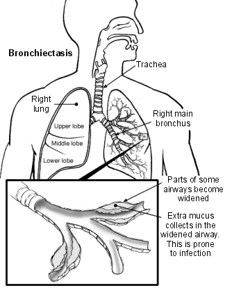 Bronchiectasis: Causes, Symptoms, and Treatment