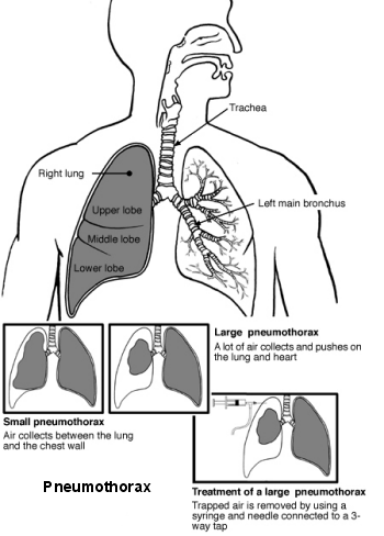 Pneumothorax (Collapsed Lung): Symptoms and Treatment